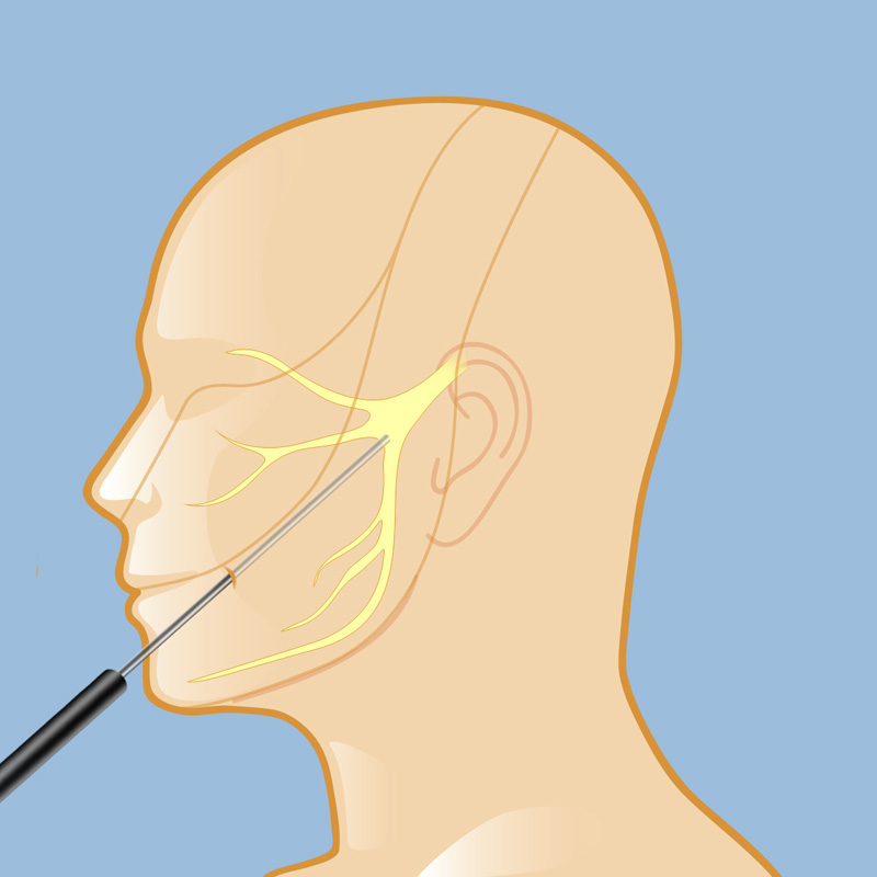 Surgery For Trigeminal Neuralgia Weill Cornell Brain And Spine Center Surgery For Trigeminal Neuralgia Weill Cornell Brain And Spine Center