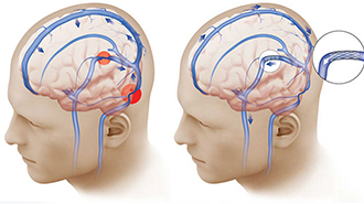 Venous Sinus Stenting Program | Weill Cornell Brain and Spine Center